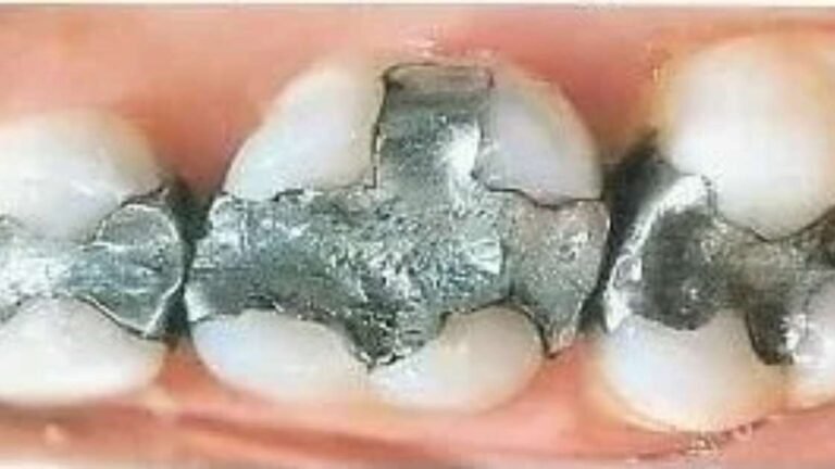 How Much Does It Cost To Fix A Cavity? Professional Guide