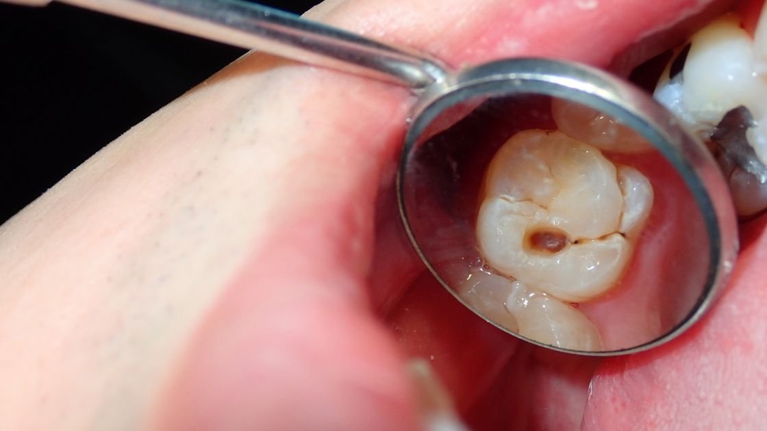 How Much Does It Cost To Fix A Cavity? Professional Guide